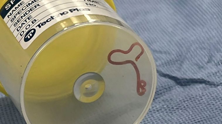 Doctors Discover Live Parasitic Worm Inside a Woman's Brain - Lens