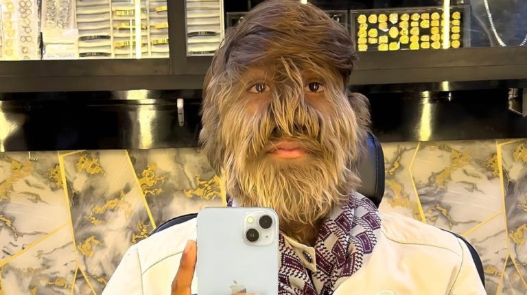 Teens Sets Guinness World Record for Hairiest Face in the World